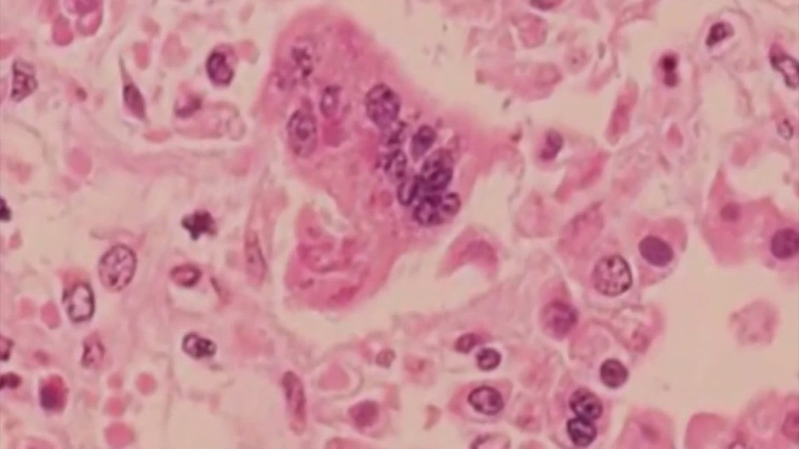 United Family pharmacies have MMR vaccines availability amid measles ...
